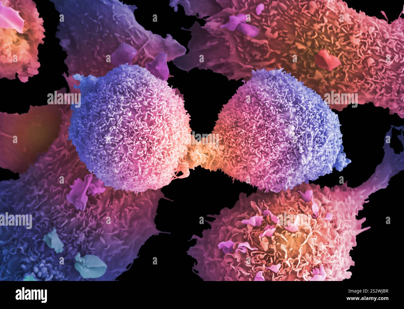 Lung cancer cells dividing, SEM Stock Photo - Alamy