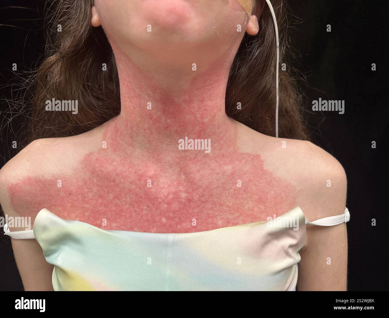 Rash on the upper chest and neck of an 11 year old female Hispanic ...