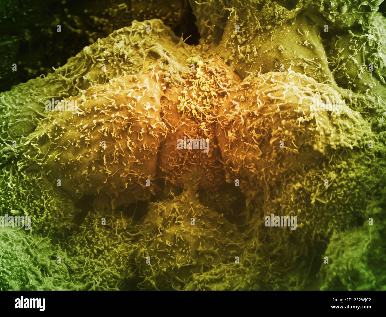 Prostate cancer cells, SEM Stock Photo - Alamy