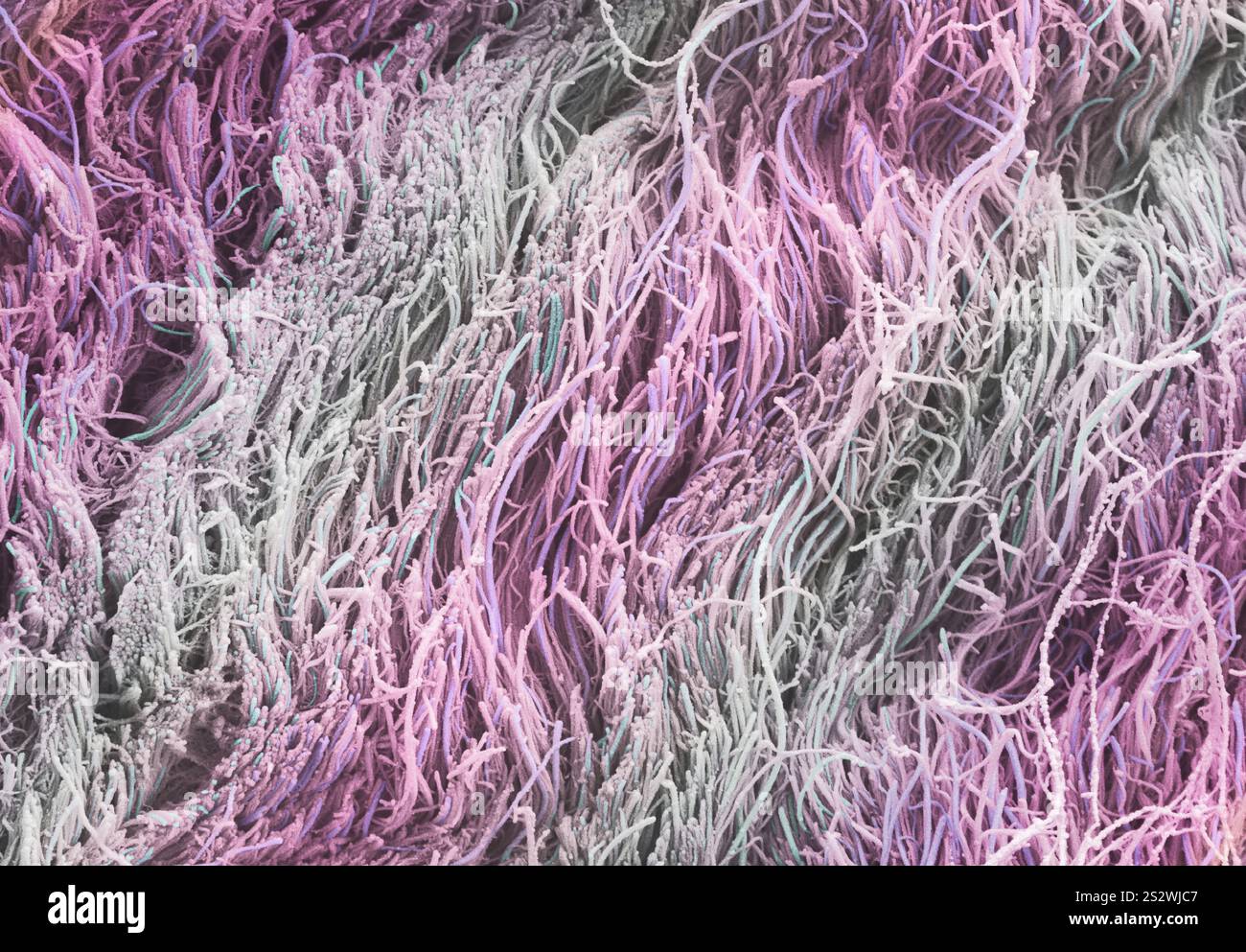 Cartilage removed from a human knee during arthroscopic surgery ...