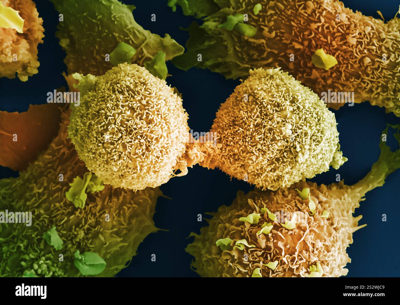 Lung cancer cells dividing, SEM Stock Photo - Alamy