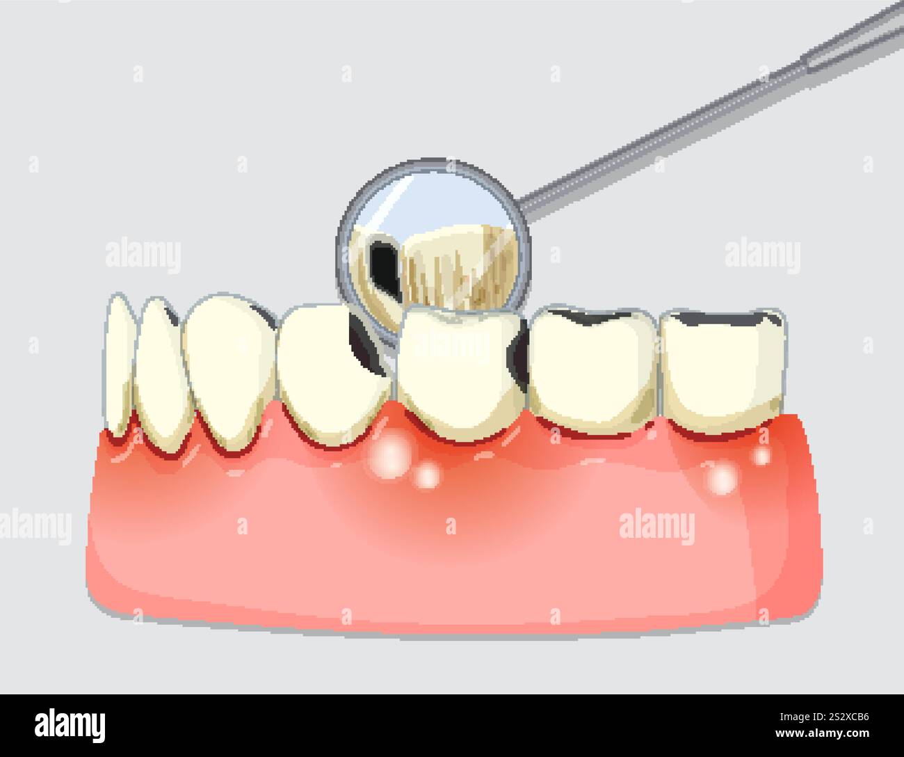 Illustration of teeth and dental examination tool Stock Vector Image ...