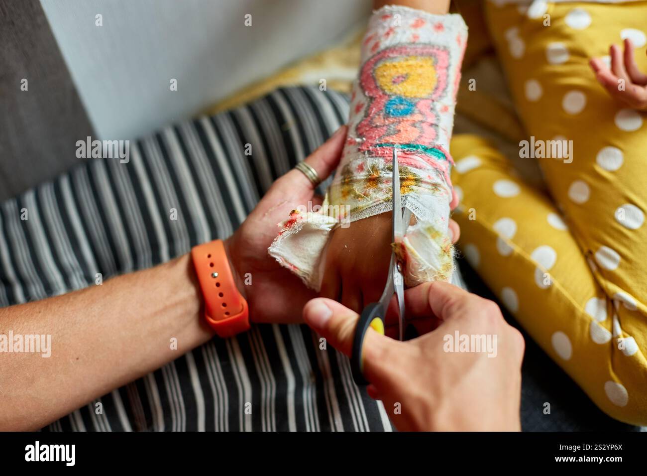 Father removing a plaster cast teen girl with a broken arm orthopedic ...