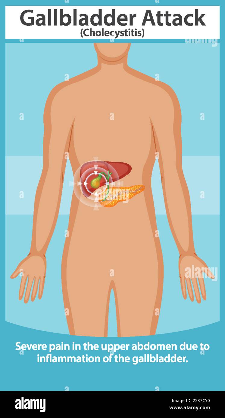 Illustration of gallbladder inflammation and pain location Stock Vector ...