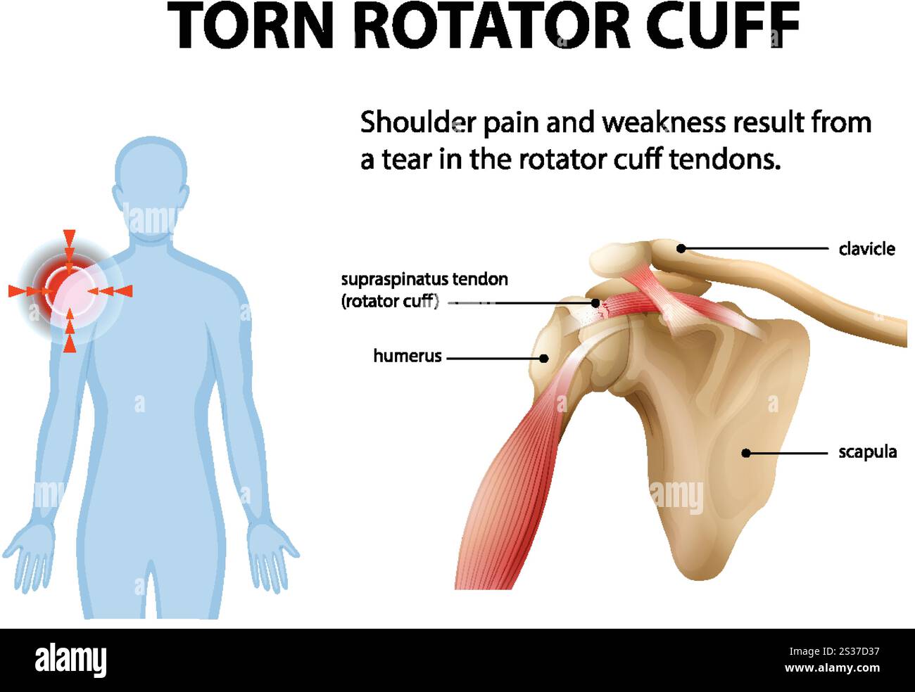 Illustration of shoulder anatomy and injury details Stock Vector Image ...