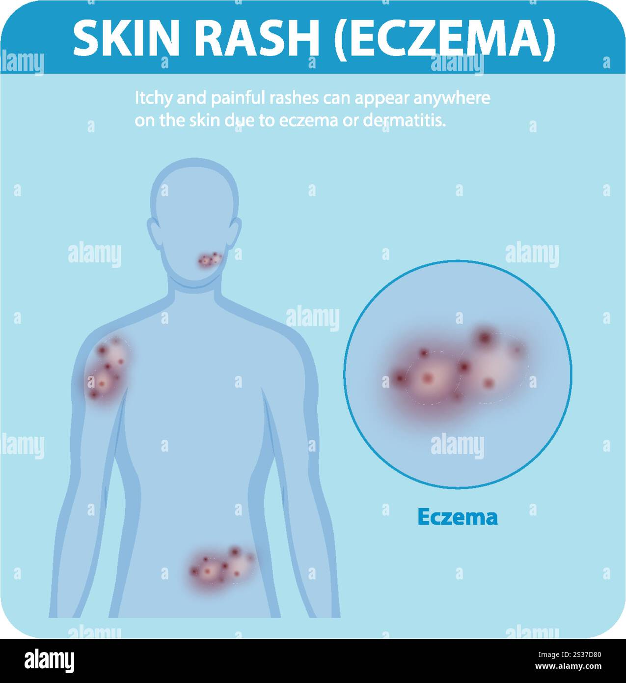 Illustration of eczema symptoms on human skin Stock Vector Image & Art ...