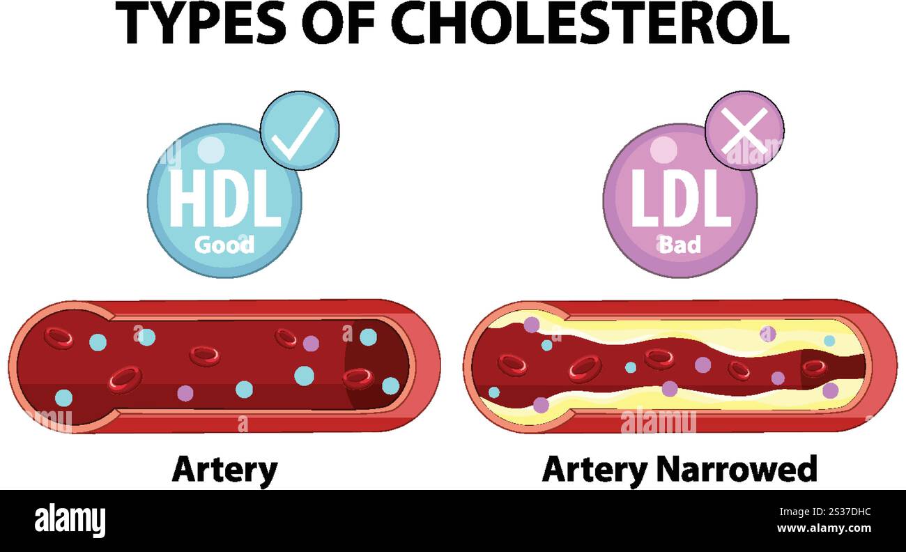 Illustration of HDL and LDL cholesterol effects Stock Vector Image ...