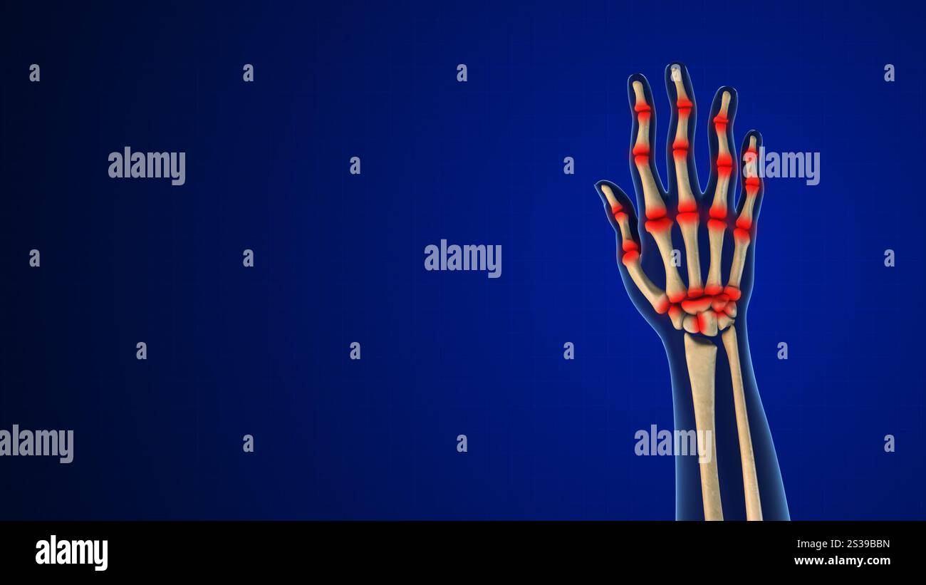 Severe Hand Arthritis with Copy Space Stock Photo - Alamy