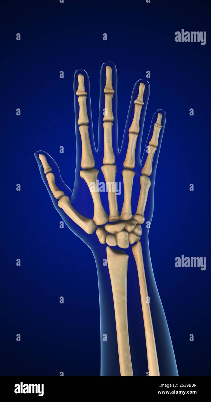 Stages of From Mild Hand Arthritis Stock Photo - Alamy