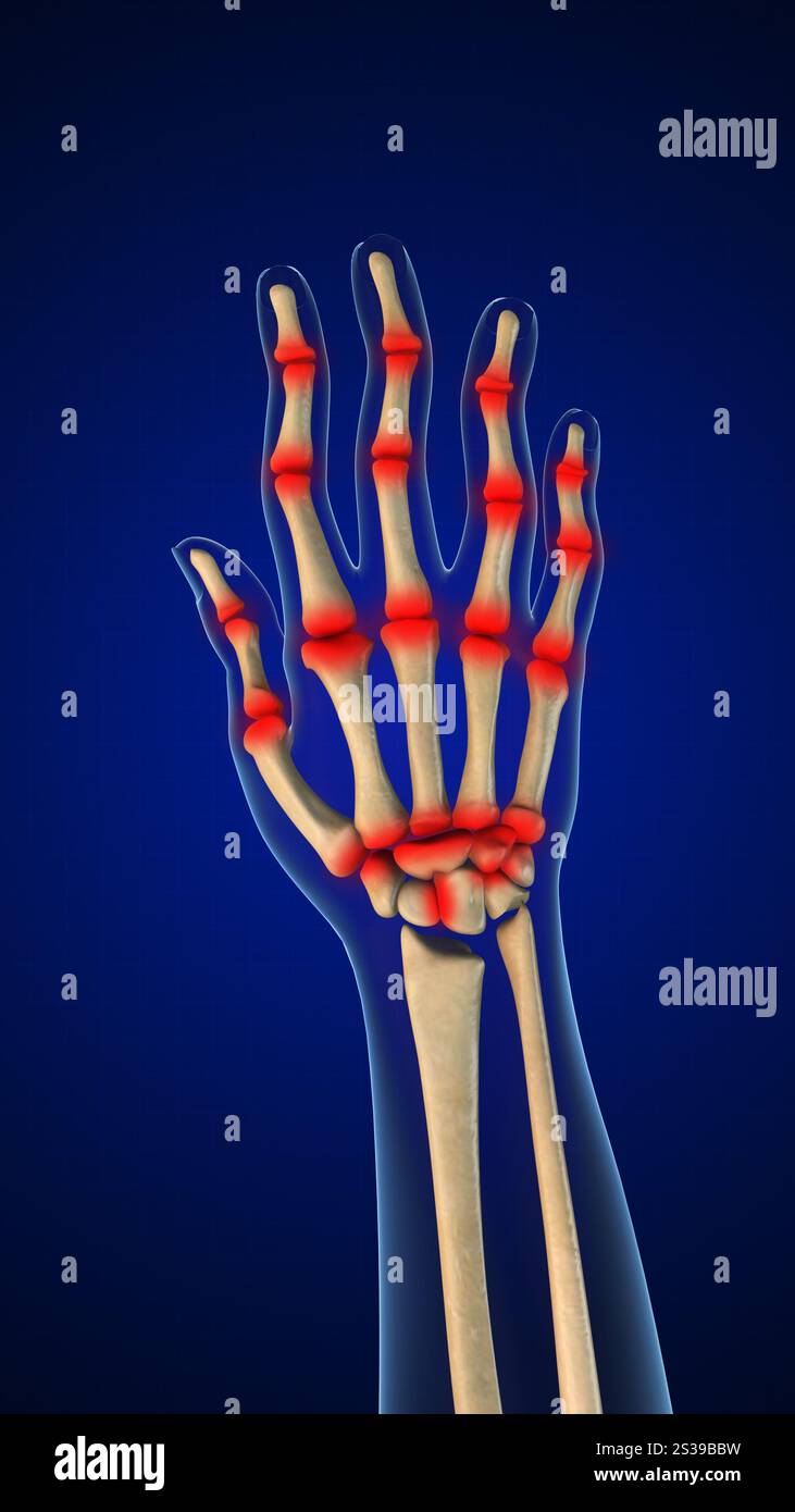 Stages of Severe Hand Arthritis Stock Photo - Alamy