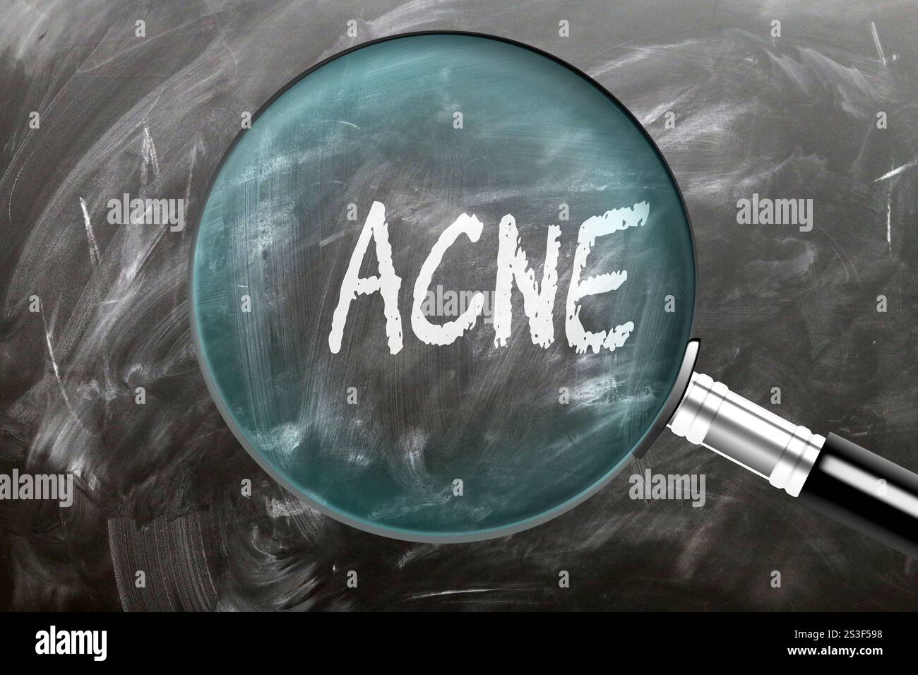 Acne learn hi-res stock photography and images - Alamy