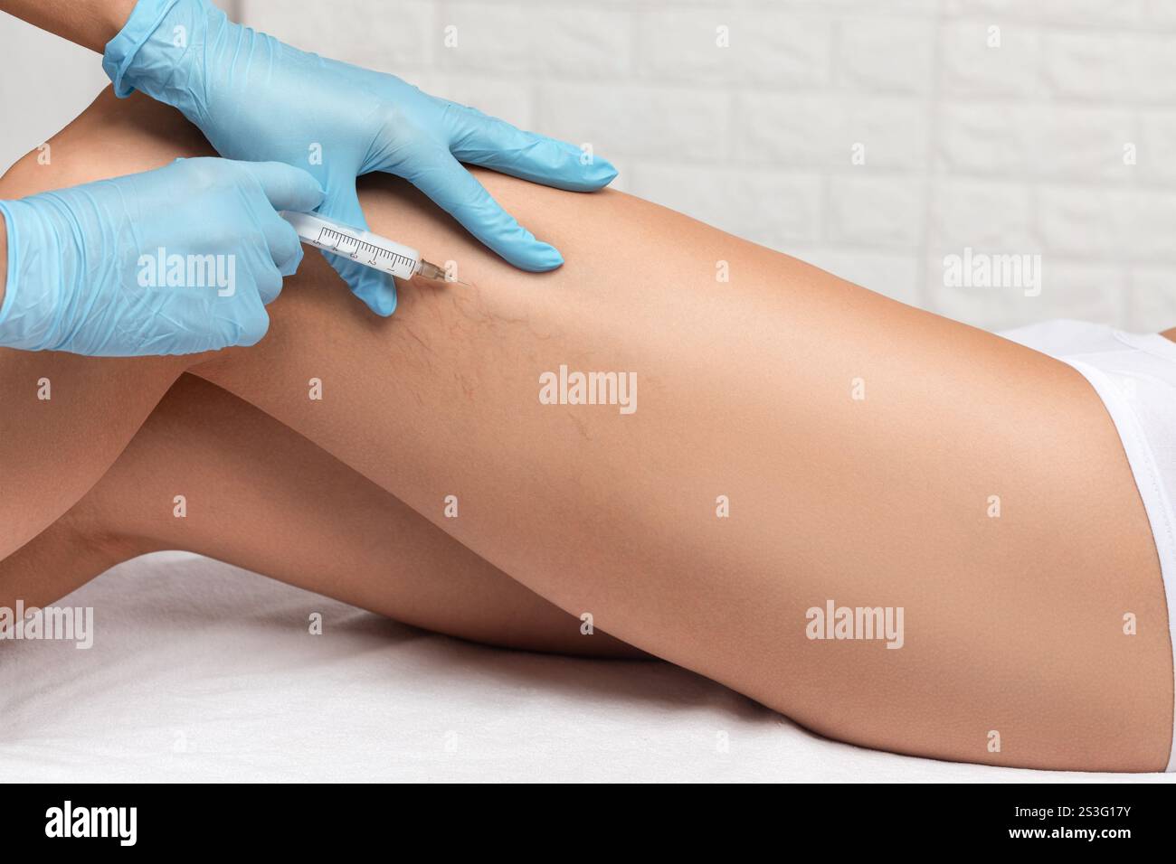 Removal of varicose veins on the legs. Medical inspection and treatment ...