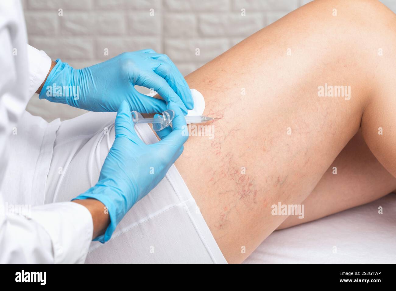 Removal of varicose veins on the legs. Medical inspection and treatment ...