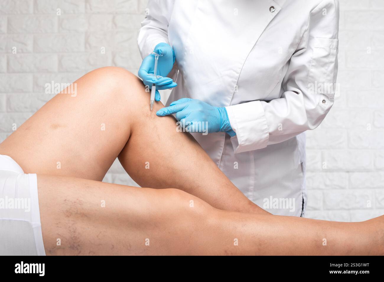 Removal of varicose veins on the legs. Medical inspection and treatment ...