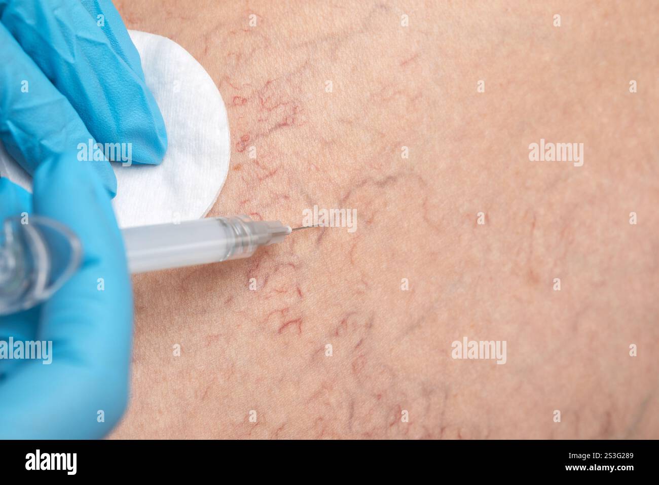 Removal of varicose veins on the legs. Medical inspection and treatment ...