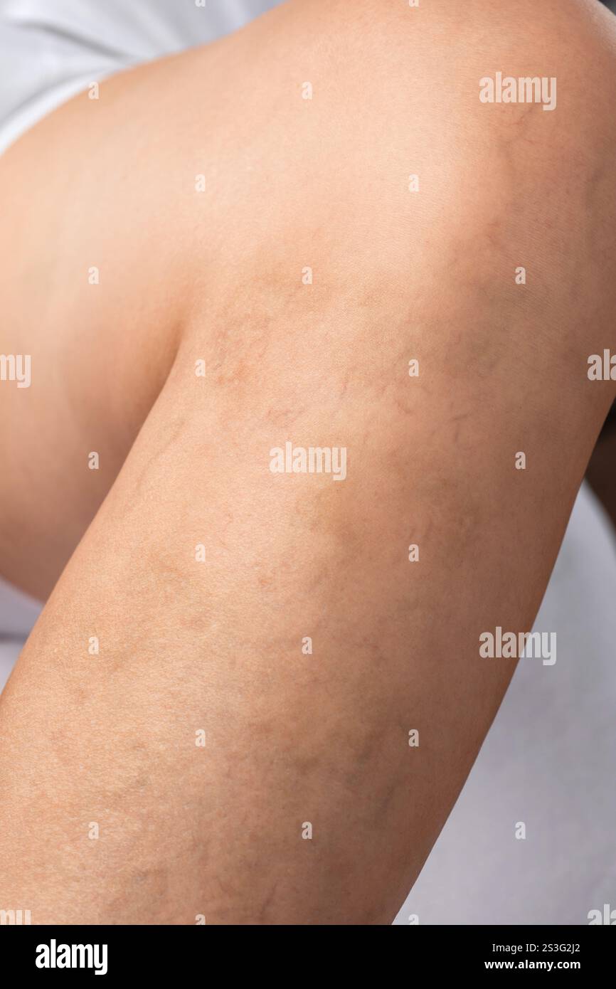 doctor shows the dilation of small blood vessels of the skin on the leg ...