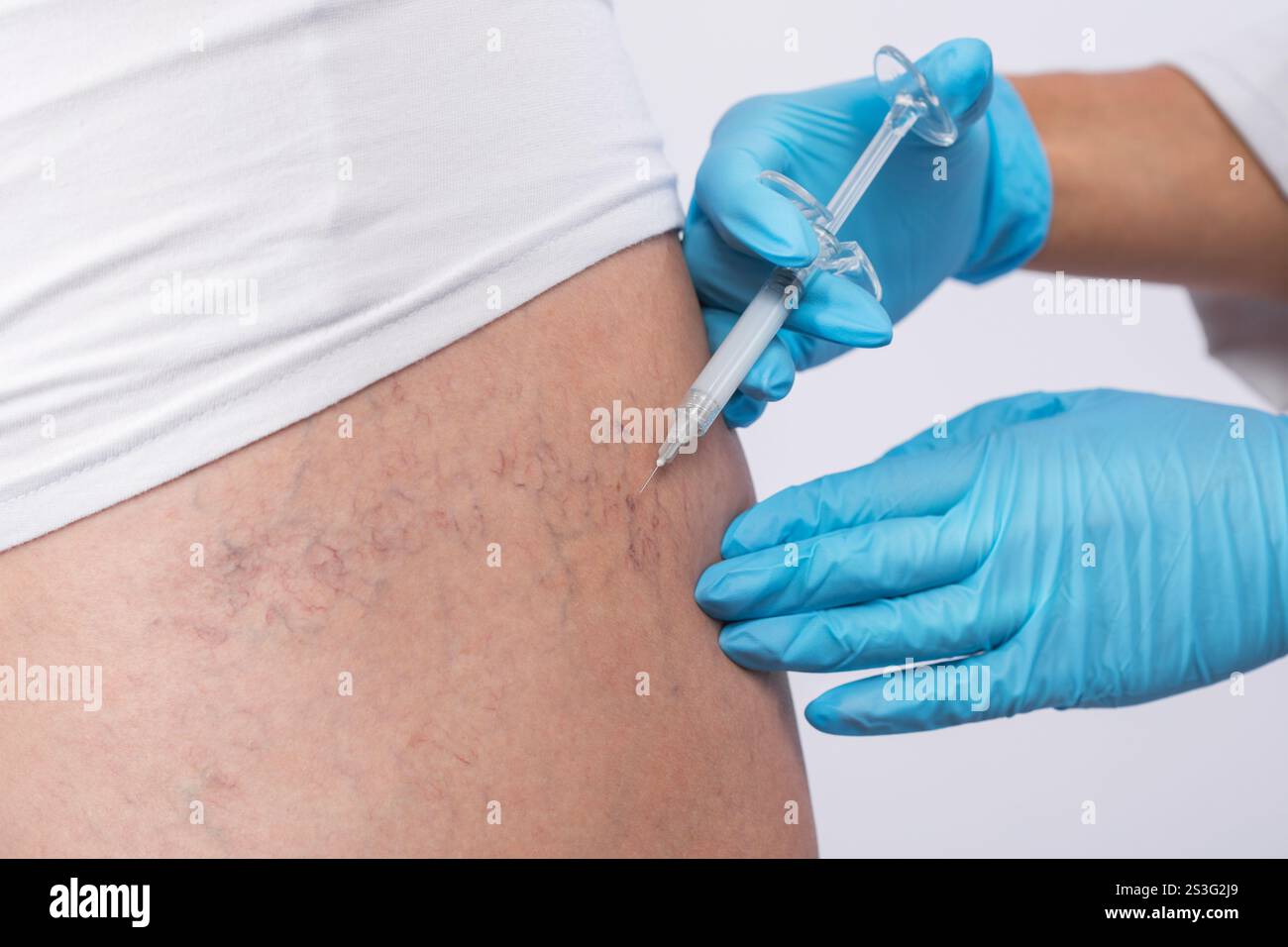 Removal of varicose veins on the legs. Medical inspection and treatment ...