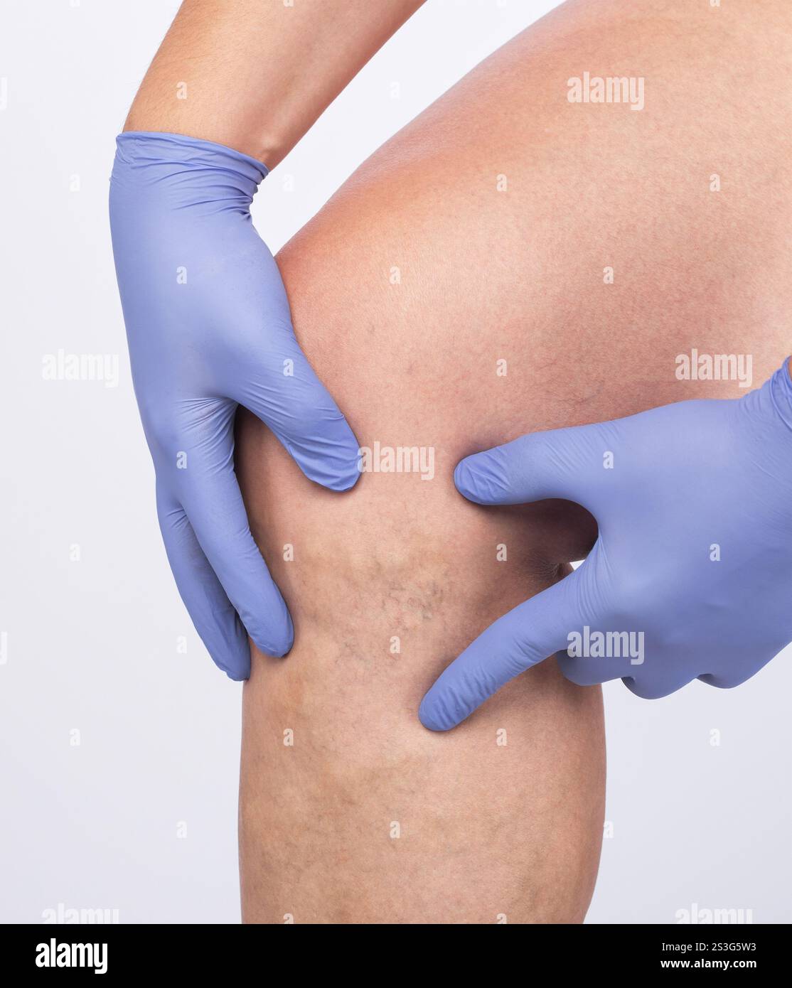 Removal of varicose veins on the legs. Medical inspection and treatment ...