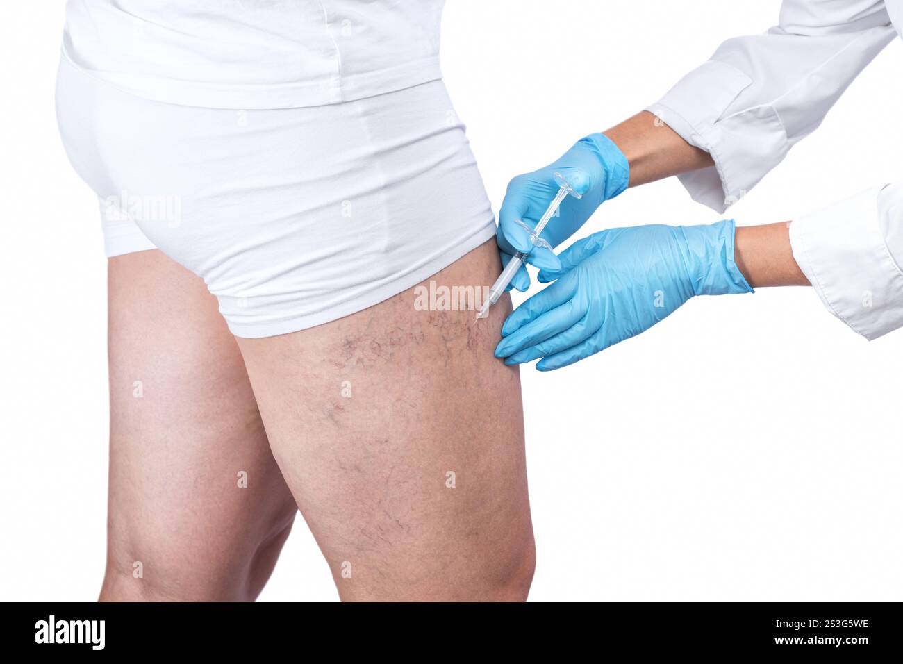 Removal of varicose veins on the legs. Medical inspection and treatment ...