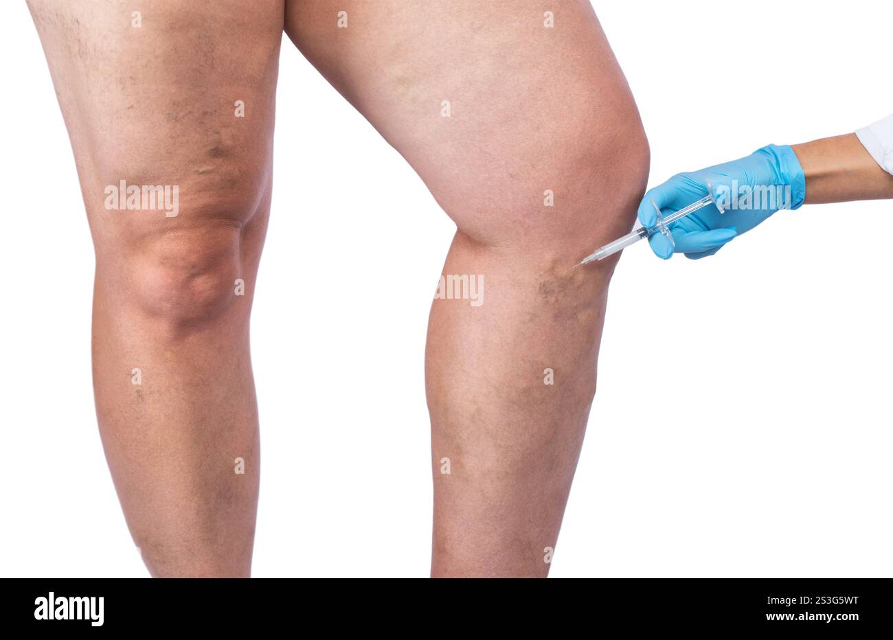 Removal of varicose veins on the legs. Medical inspection and treatment ...