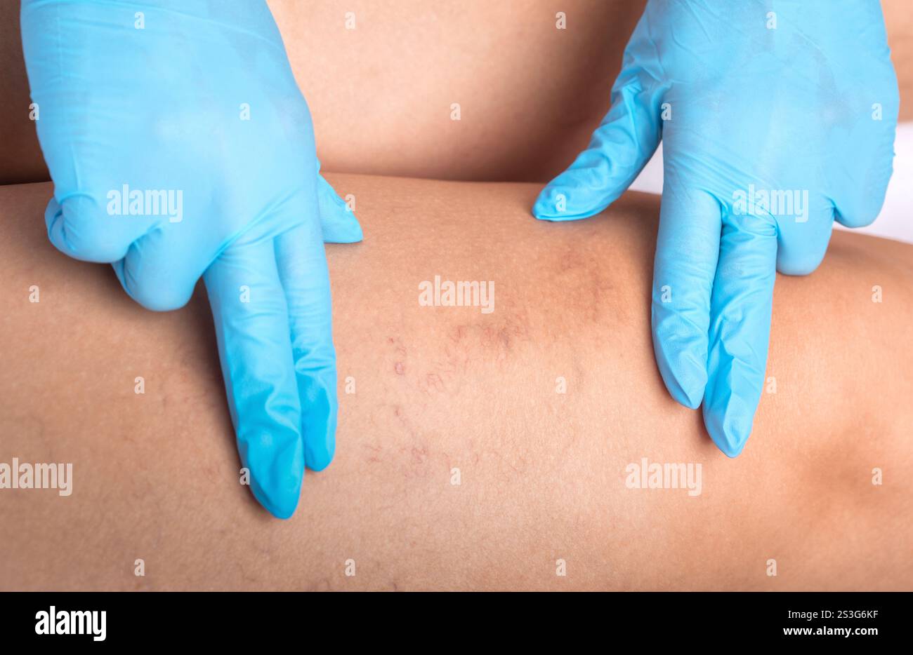 Removal of varicose veins on the legs. Medical inspection and treatment ...