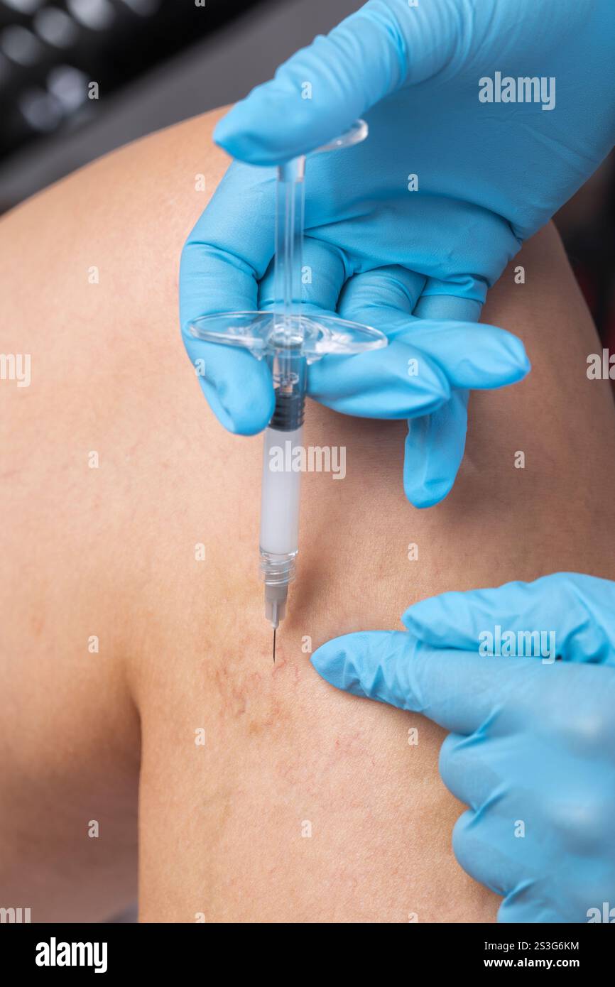 Removal of varicose veins on the legs. Medical inspection and treatment ...