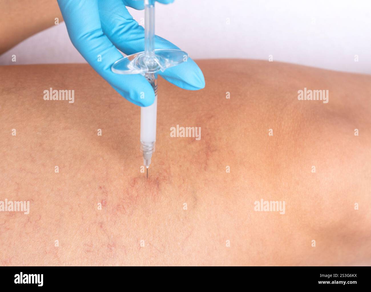 Removal of varicose veins on the legs. Medical inspection and treatment ...