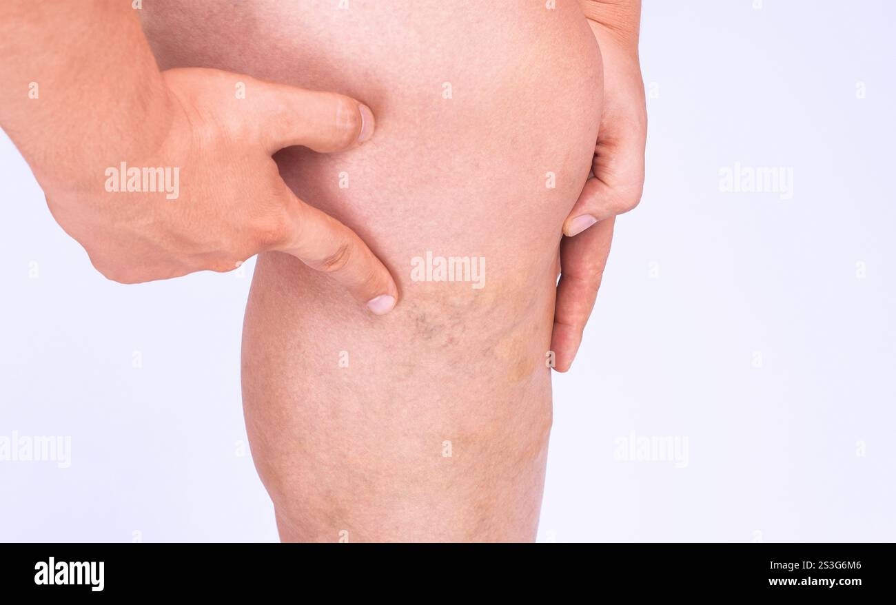 Removal of varicose veins on the legs. Medical inspection and treatment ...