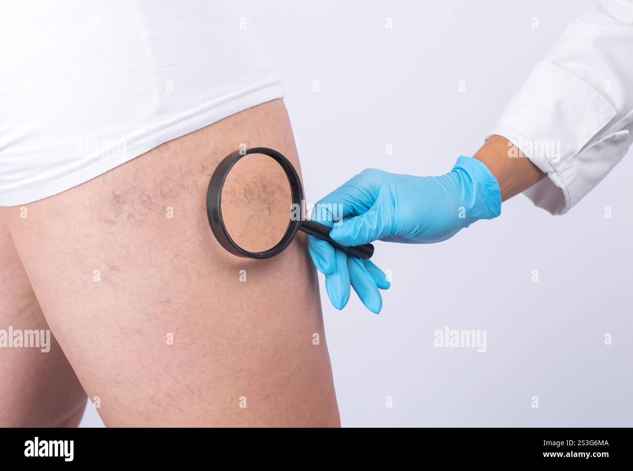 Removal of varicose veins on the legs. Medical inspection and treatment ...