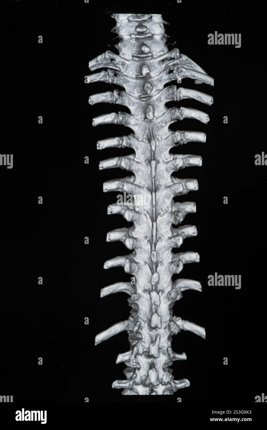Spinal mri images Stock Photo - Alamy