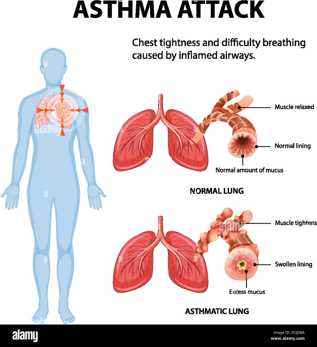 Illustration of normal and asthmatic lung conditions Stock Vector Image ...