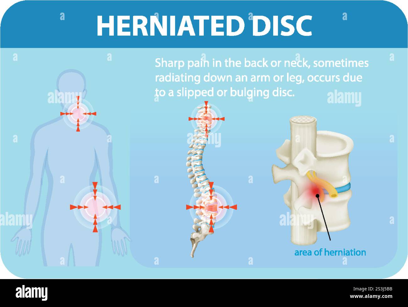 Illustration of herniated disc and pain areas Stock Vector Image & Art ...