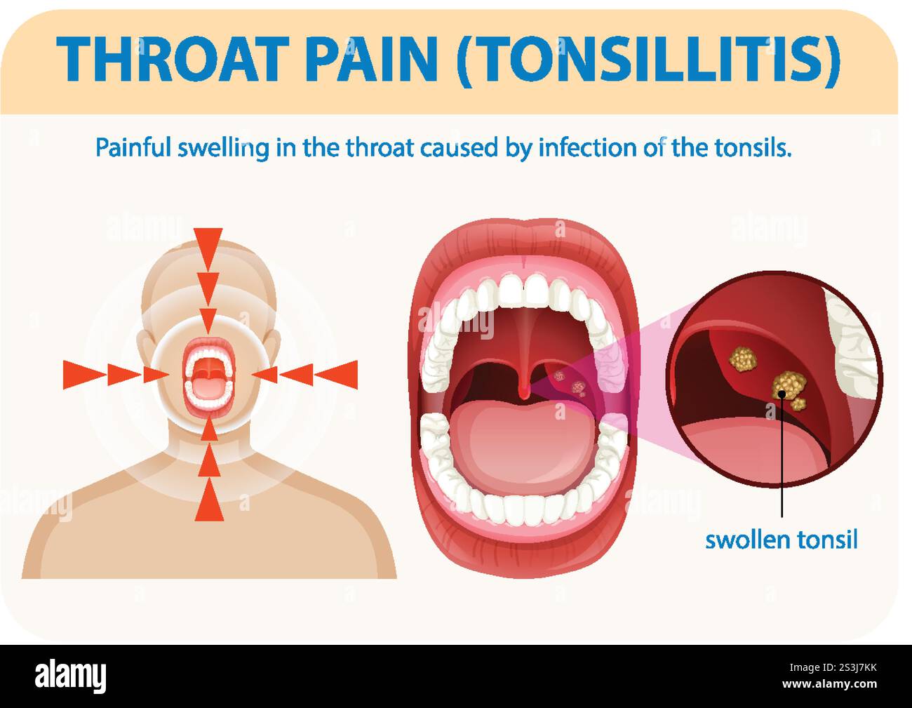 Illustration of throat pain caused by tonsillitis Stock Vector Image ...
