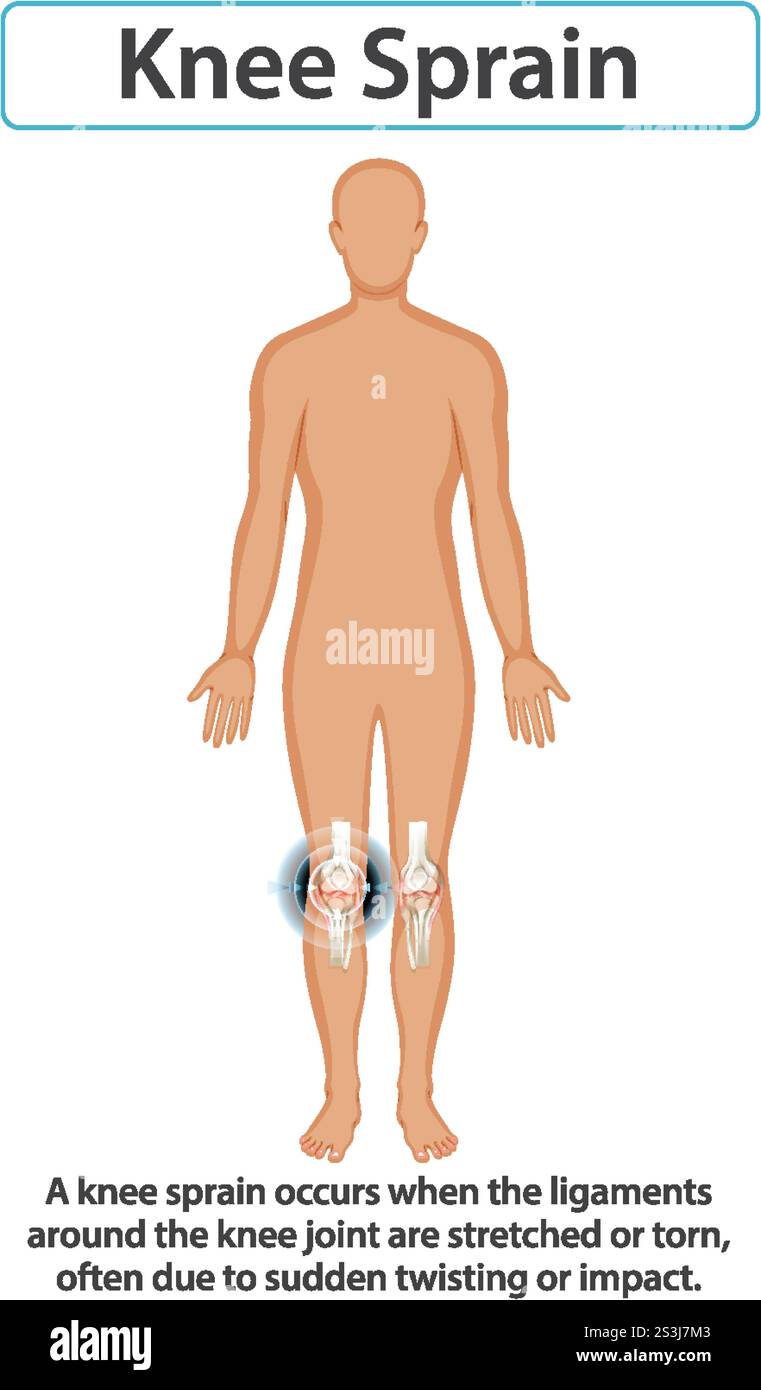 Illustration of knee sprain and ligament damage Stock Vector Image ...