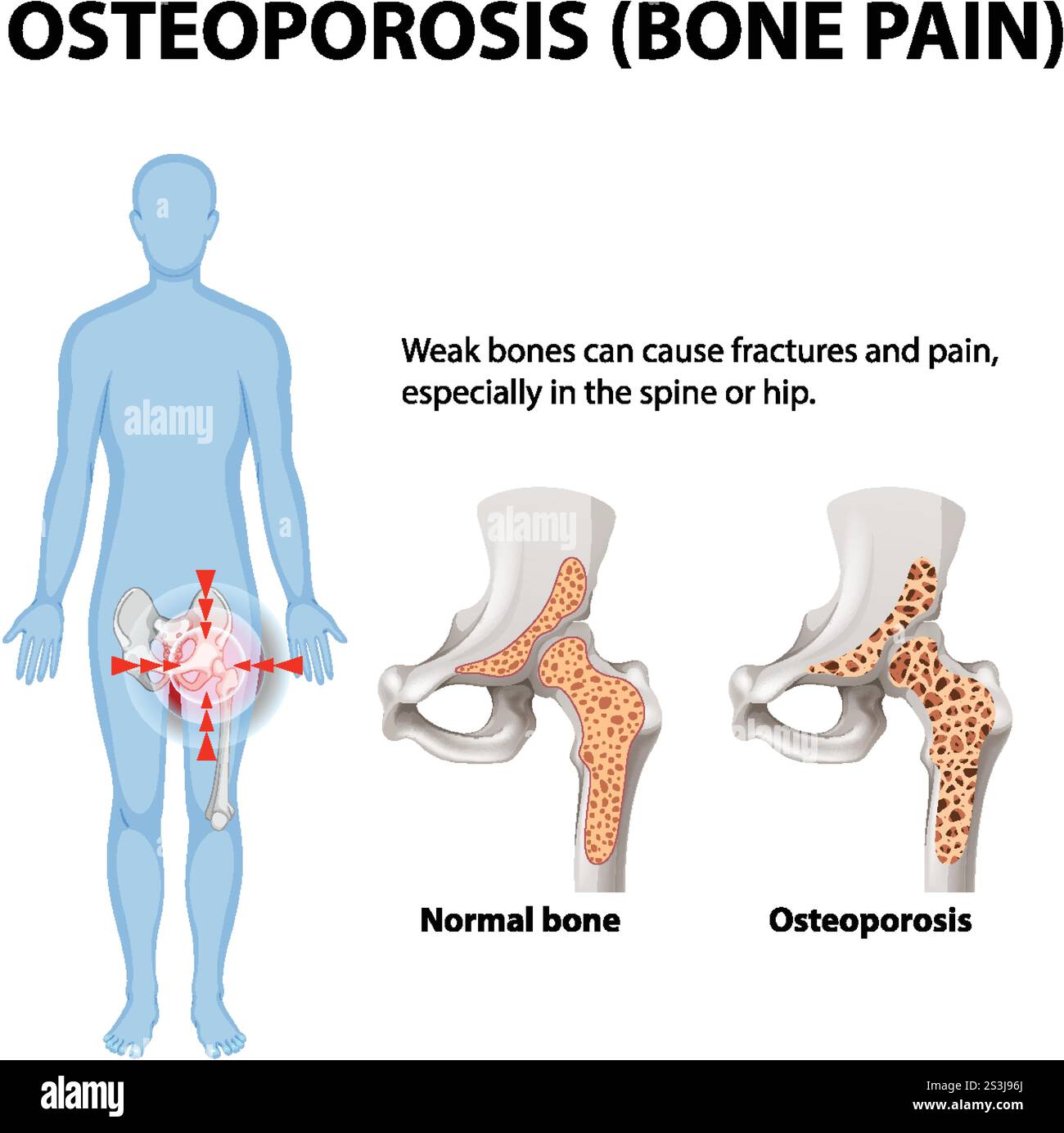 Illustration of bone pain and osteoporosis effects Stock Vector Image & Art - Alamy