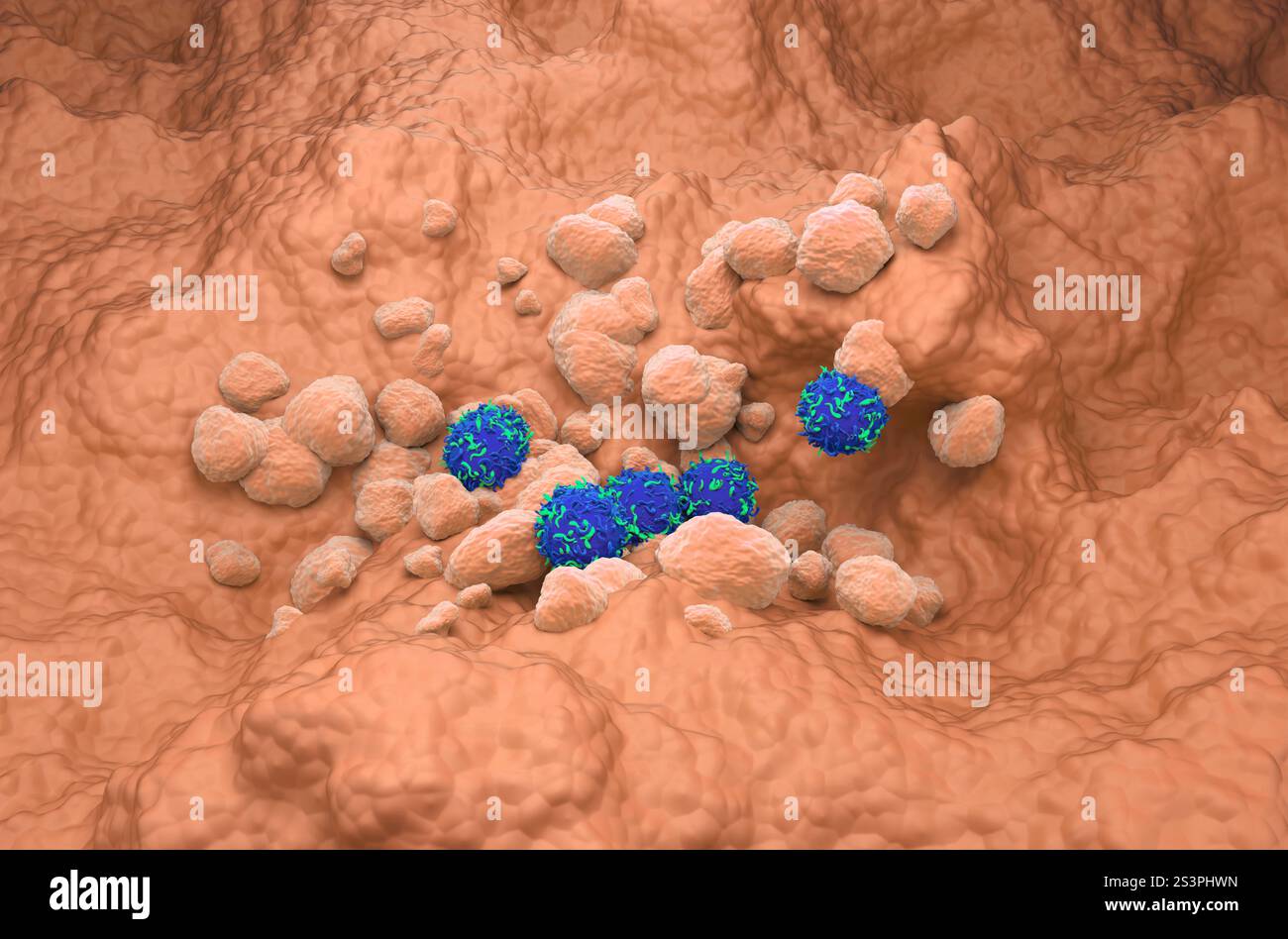 Non Small Cell Lung Cancer (NSCLC) in the lung tissue - isometric view ...