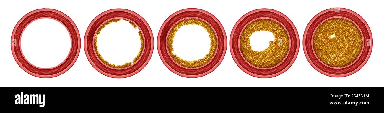 Plaque in artery Cut Out Stock Images & Pictures - Alamy