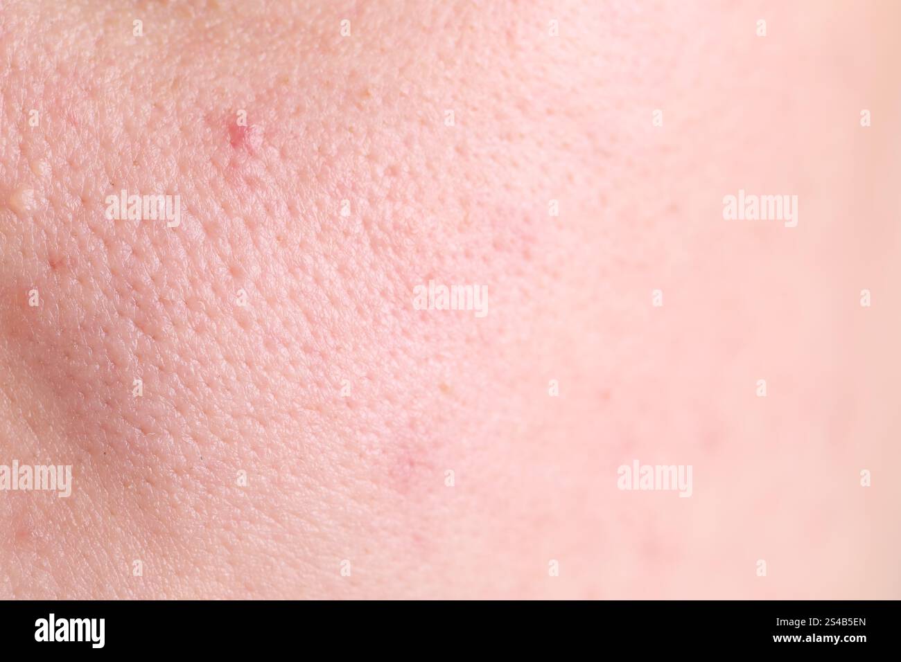 Texture of skin with enlarged pores as background, closeup Stock Photo ...