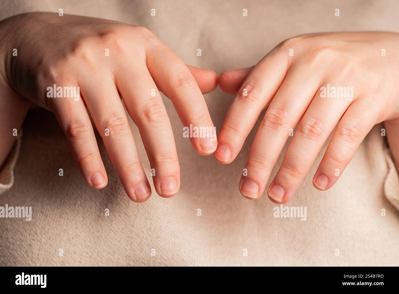 Nails in bad condition female hi-res stock photography and images - Alamy