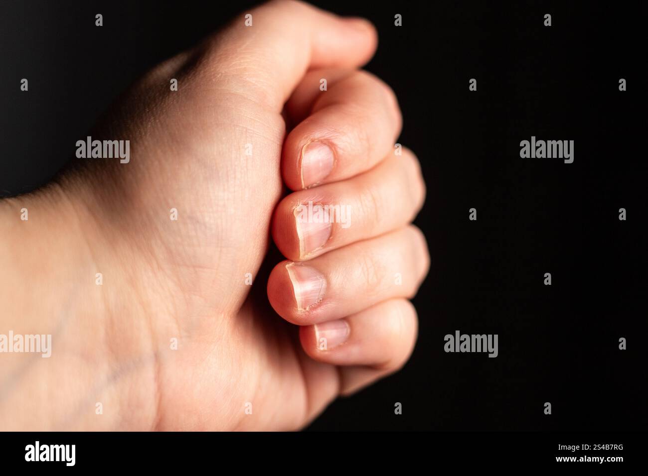 Closeup image of fingers and nails bitten. Health and medical concept ...