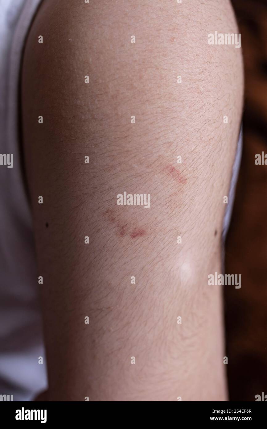 Bite marks pattern bruise on a young boys arm, bullying aggressive ...