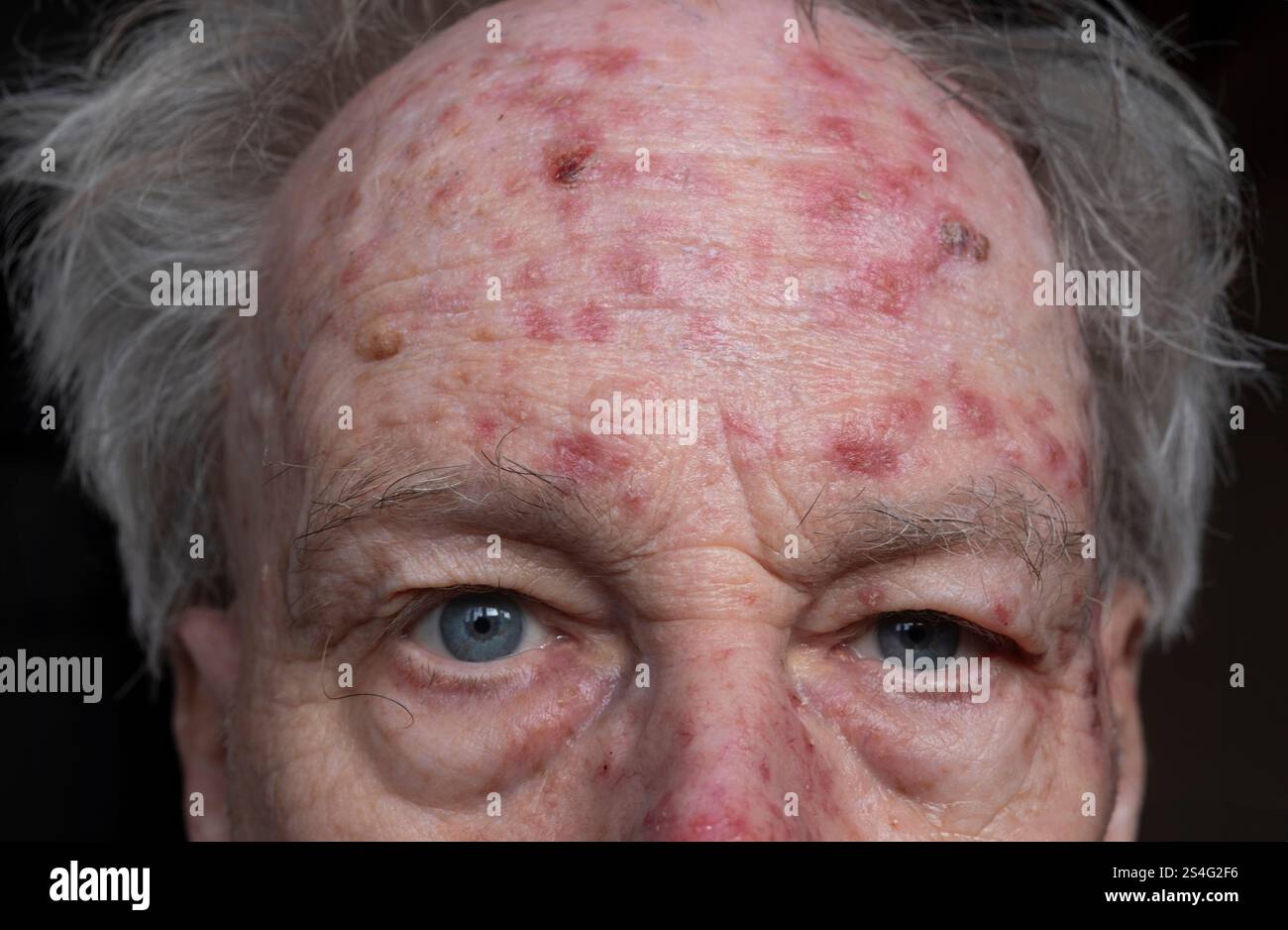 Forehead of man during treatment for actinic keratosis with Flurouracil ...