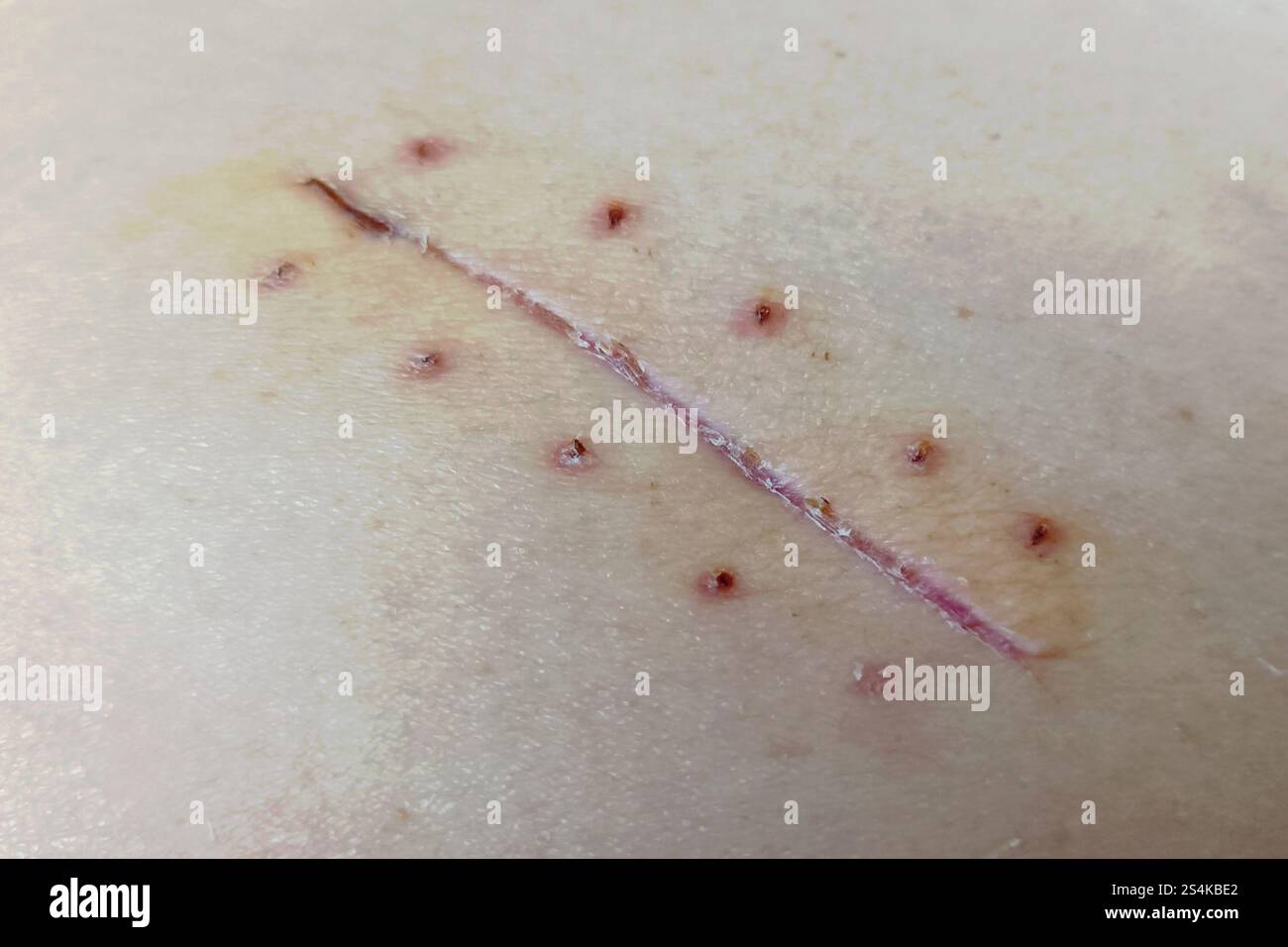 Appendectomy wound after 20 days Stock Photo - Alamy