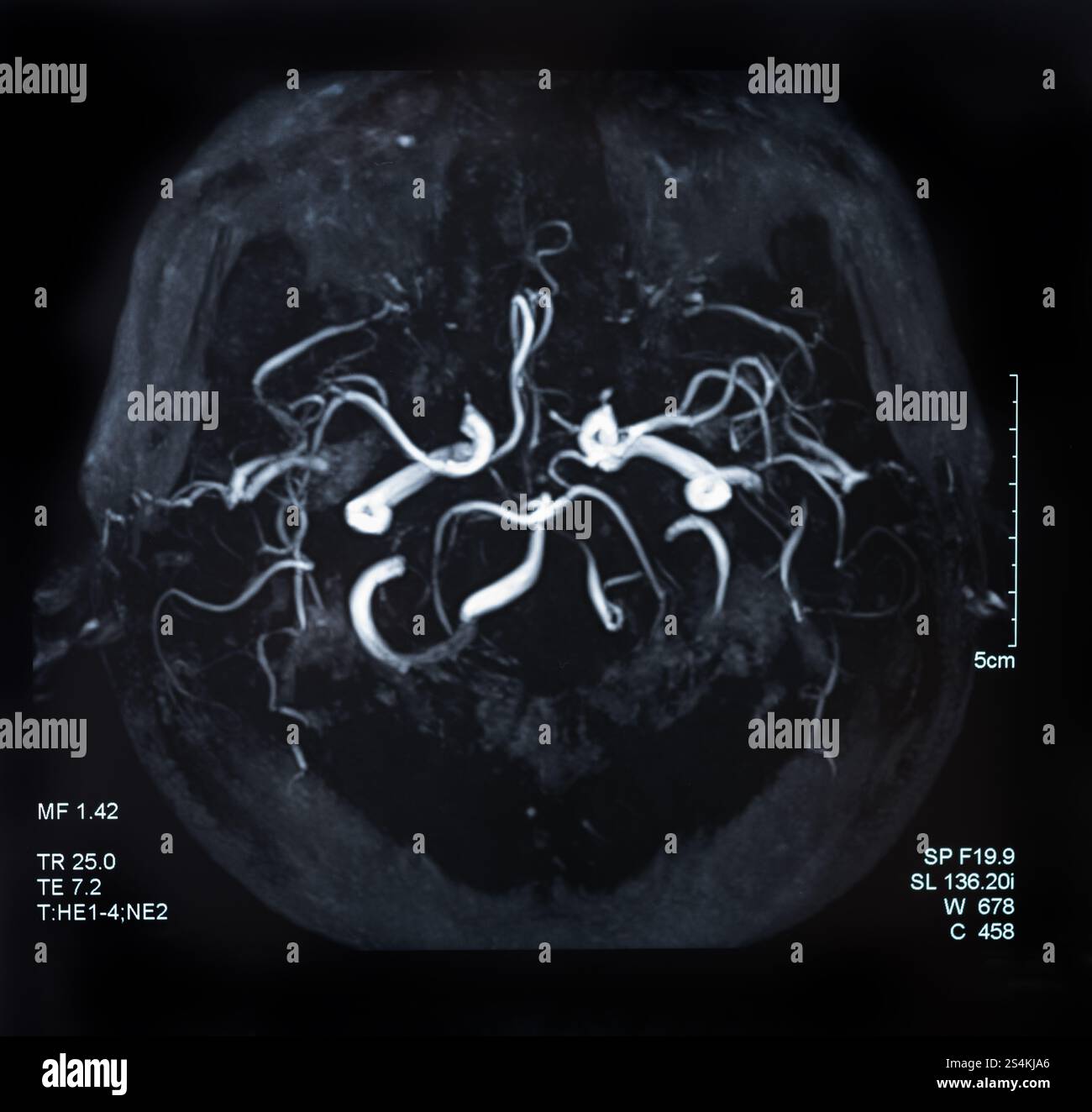 MRI of the brain stroke and cerebrovascular disease. brain x-ray image ...