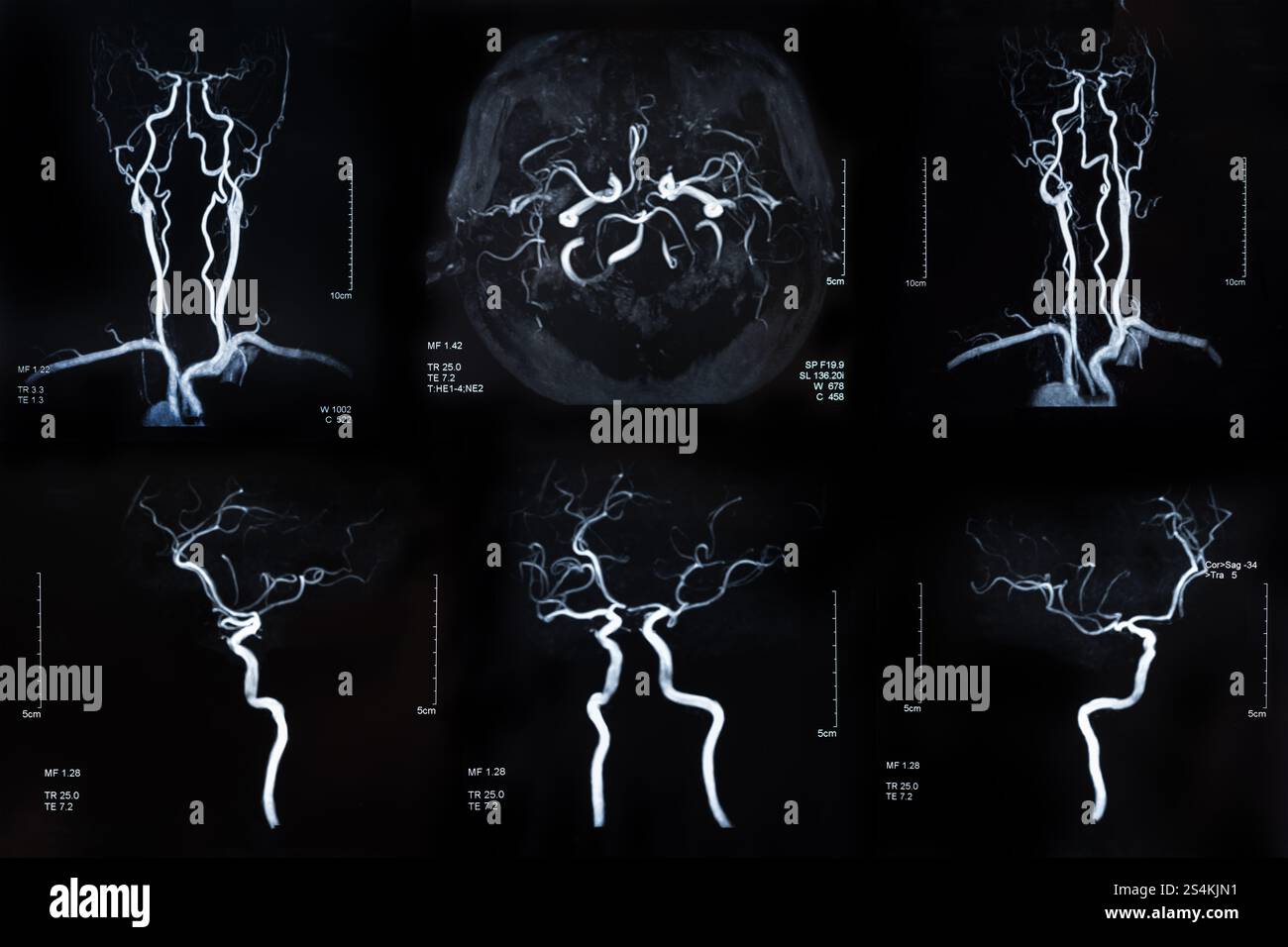 MRI of the brain stroke and cerebrovascular disease. brain x-ray image ...
