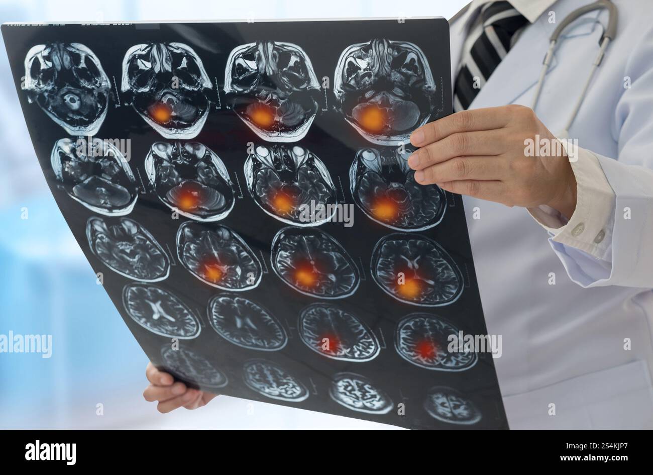 Brain tumor. Doctor examines the MRI scan brain x-ray image of the ...