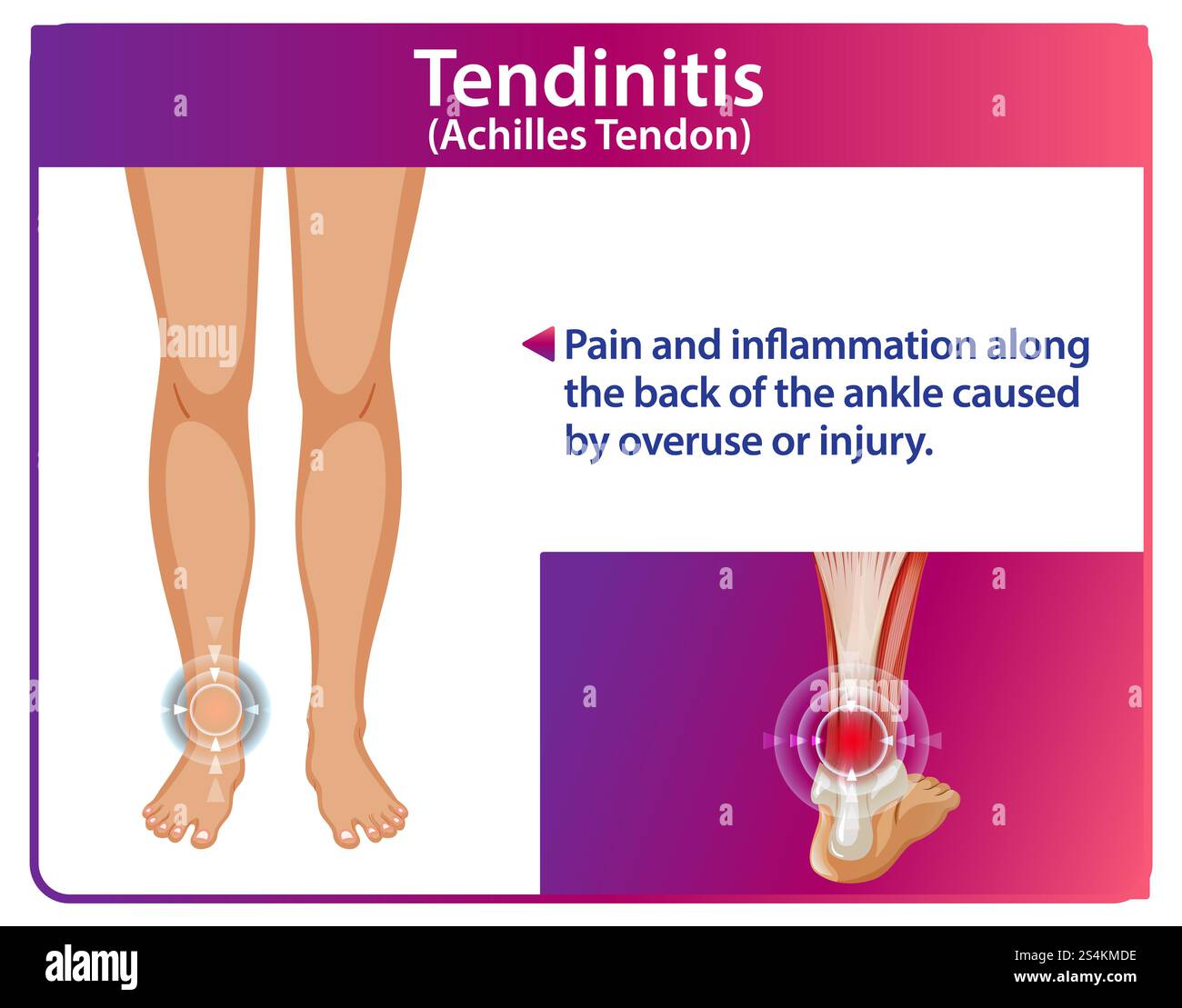 Illustration of Achilles tendon pain and inflammation Stock Photo - Alamy