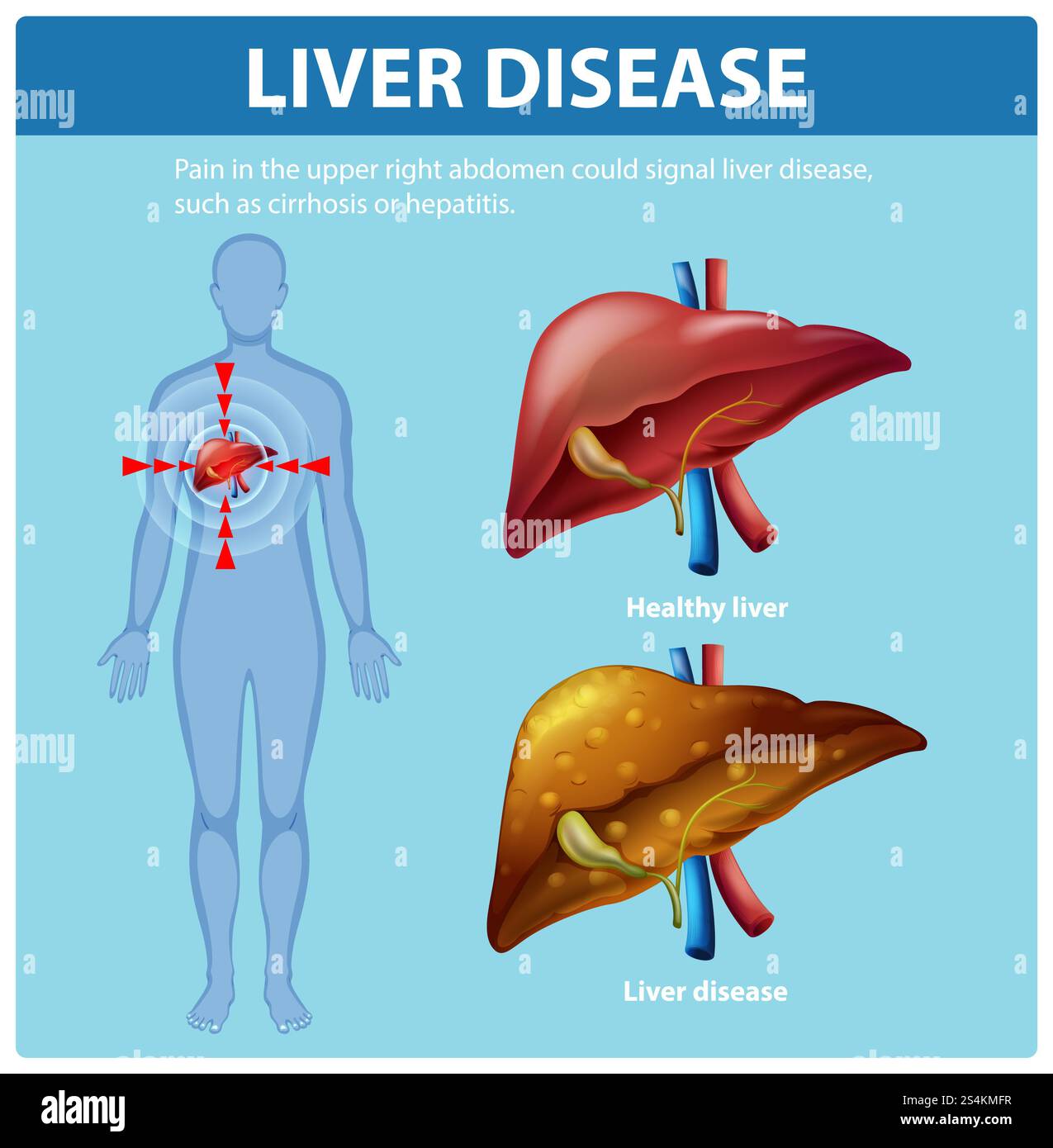 Illustration of healthy and diseased liver comparison Stock Photo - Alamy