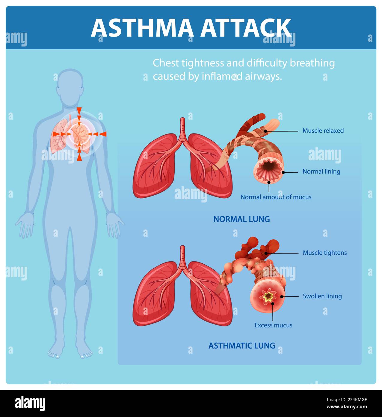 Illustration of normal and asthmatic lung conditions Stock Photo - Alamy