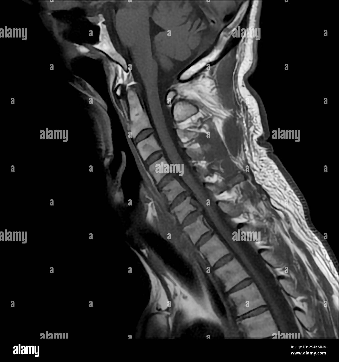 Sagittal view of magnetic resonance image of MRI of cervical spine ...